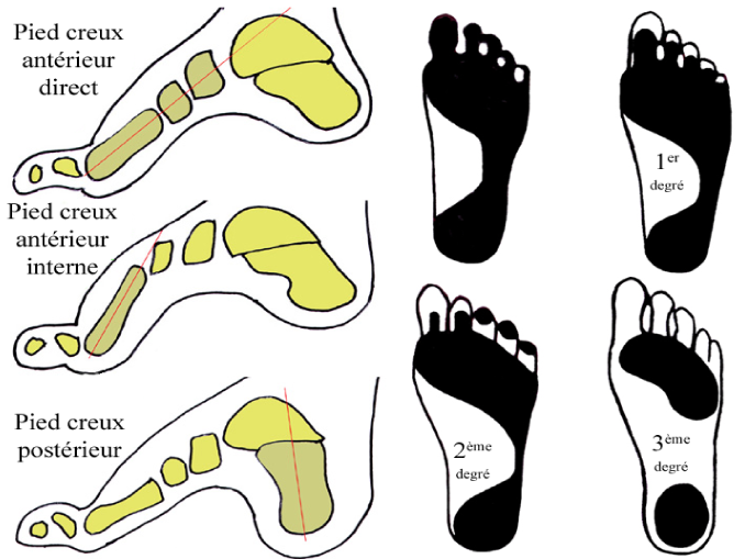 SEMELLE ORTHOPEDIQUE